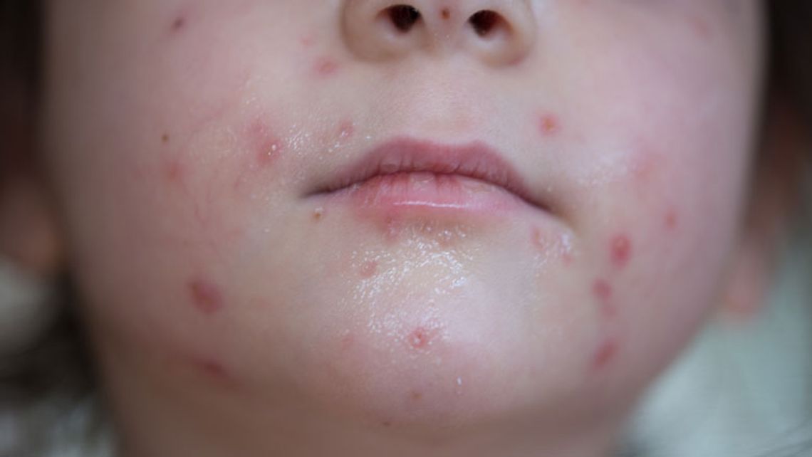 Wat is het mazelenvirus? - Radar - het consumentenprogramma van AVROTROS