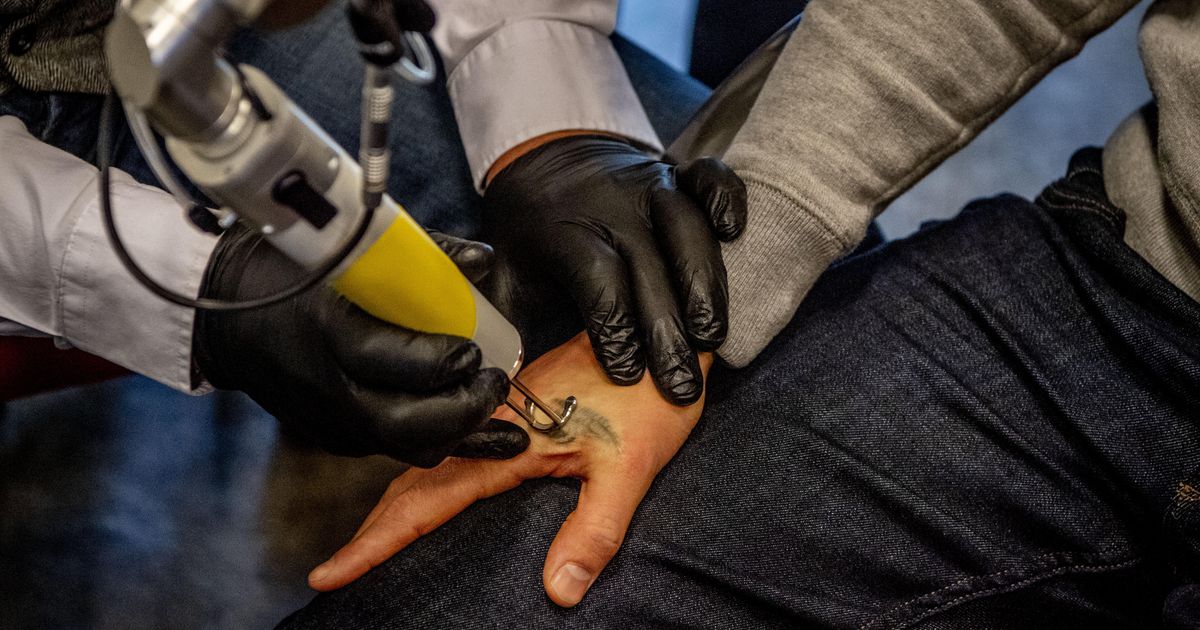 Huidproblemen door weglaseren tatoeage? Meld het bij deze instanties ...