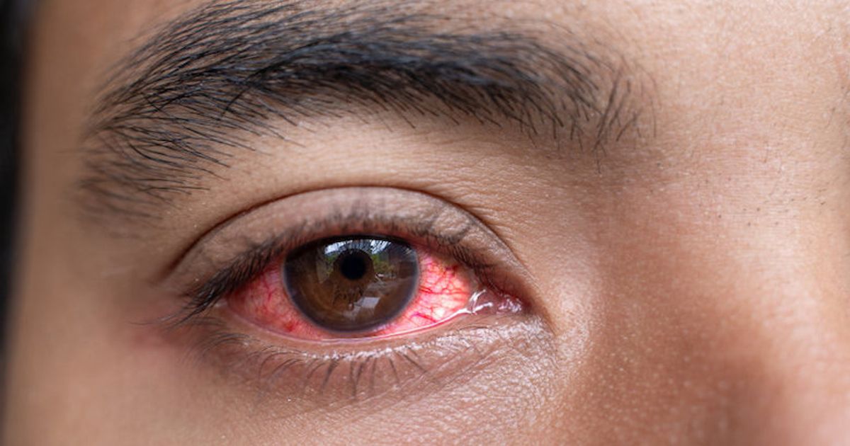 Rode vaatjes in de ogen: waar komt het precies door en wat kun je ...