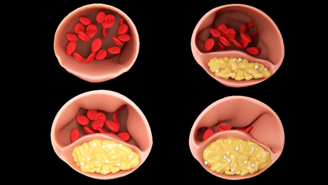 Wat is slagaderverkalking? - Radar - het consumentenprogramma van AVROTROS