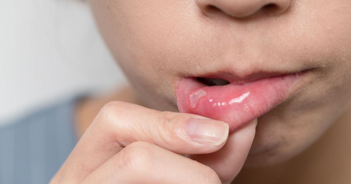 Aften in je mond: waardoor ontstaan ze en hoe kom je er vanaf? | Radar ...